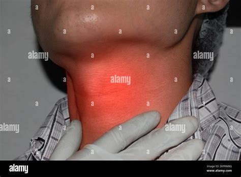 Redness At Neck Of Asian Myanmar Young Man Concept Of Sore Throat