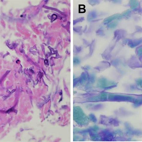 Felsons Classification Of Mediastinum In Anterior Middle And