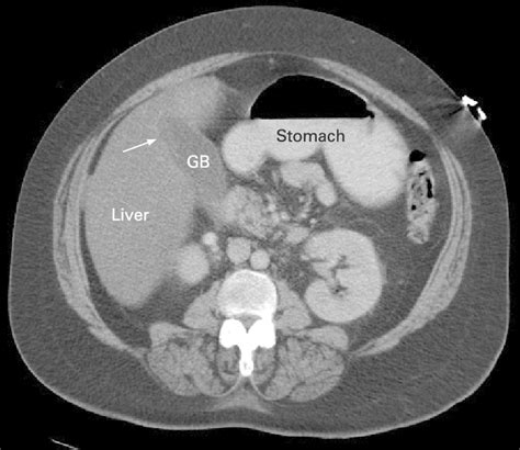 Axial Postcontrast Ct Image Showing Focal Thickening And Mild