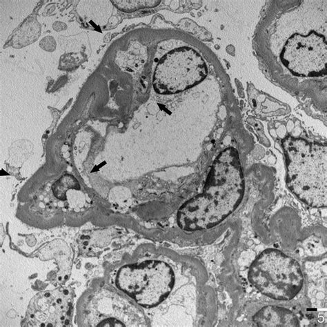 Diffuse Subendothelial Edema And Glomerular Basement Membrane Download Scientific Diagram