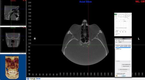 Diagnostic Accuracy Of Lateral Cephalograms And Cone Beam Computed Tomography For The Assessment