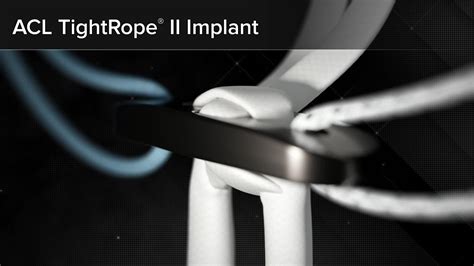 Arthrex Acl Tightrope® Ii Implant