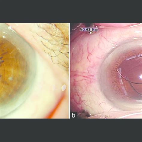 A The Linear Circumferential Laceration Of The Capsular Bag At The Download Scientific