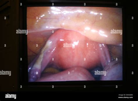 GYNECOLOGICAL SURGERY ENDOSCOPY Stock Photo Alamy