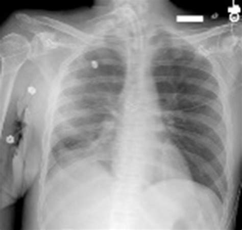 Labs Drawn For Pneumonia