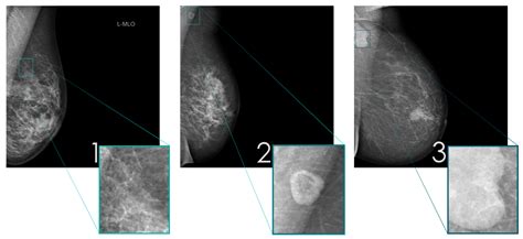 Flowers Hospital Mammogram Best Flower Site