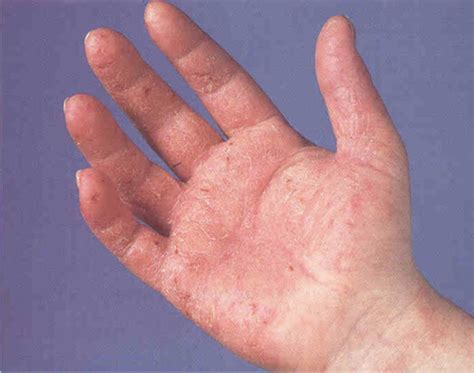 Cms I Dermatology Rashes Flashcards Quizlet