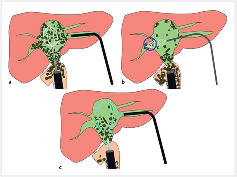 Combined Endoscopic Lithotripsy And Percutaneous Transhepatic