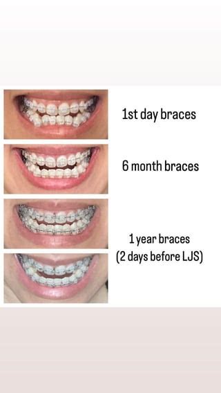 1 Year 2 Months Braces 2 Months Po Ljs R Jawsurgery