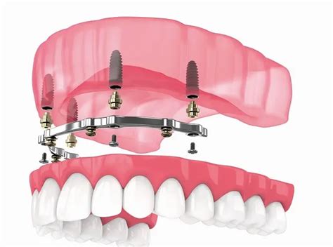 Understanding About Implant Bar Overdenture Vta Dental Lab