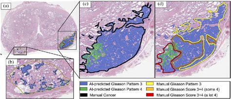 Figure 1 From A Review Of Artificial Intelligence In Prostate Cancer Detection On Imaging