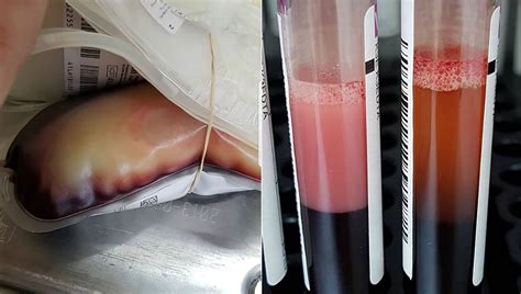 Impactantes Imágenes De La Sangre De Un Paciente Con Niveles Altos De