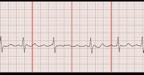 Practice Rhythm Strips