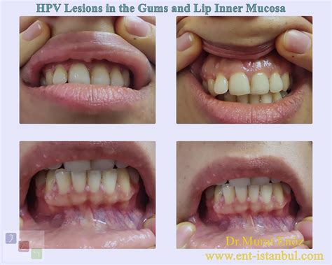 Oral Human Papillomavirus Hpv Infection Symptoms Diagnosis