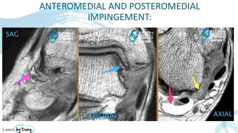 Antero Medial Ankle Impingement Mri Radedasia