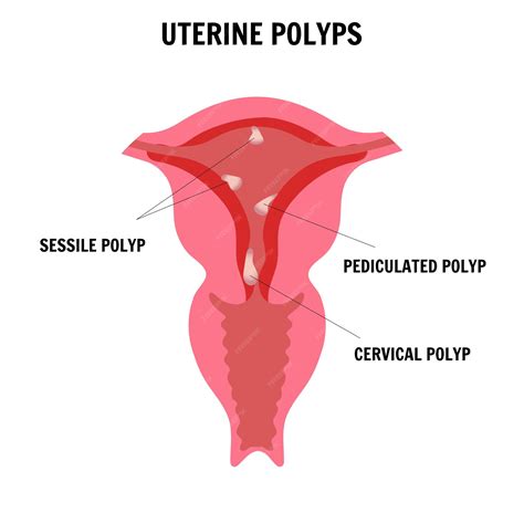 Doenças Médicas Do Sistema Reprodutivo Feminino Tipos De Pólipos Uterinos Em Ilustração Vetorial