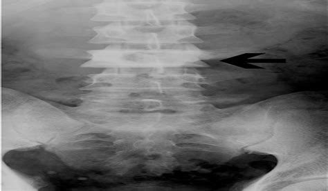 Imaging Of Multifocal And Diffuse Sclerotic Bone Lesions Contemporary