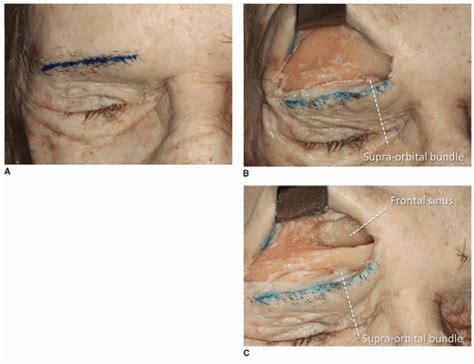 External Approaches In Sinus Surgery Ento Key