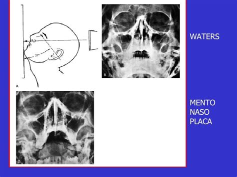 Senos Paranasales Imagenología