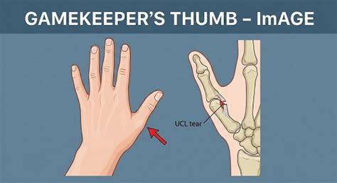 Gamekeepers Thumb Test Radiology X Ray And Mri Treatment Brace