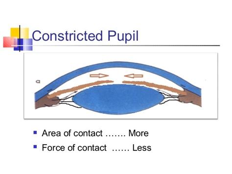 Pupil Block Glaucoma