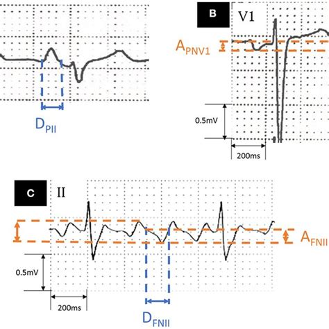 Measurement Of Ecg Parameters A Lead Ii During Sinus Rhythm B