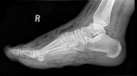 Necrotizing Fasciitis Xray