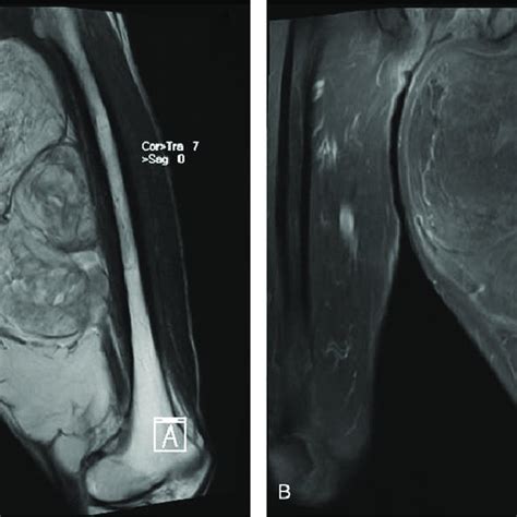 Preoperative Magnetic Resonance Imaging Findings There Was A Huge