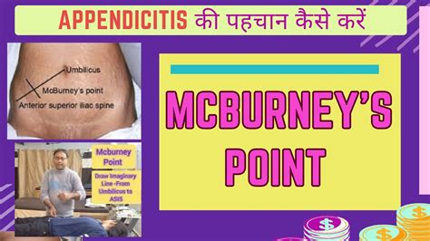 Mcburney Point For Appendicitis How To Locate Mcburney Point For