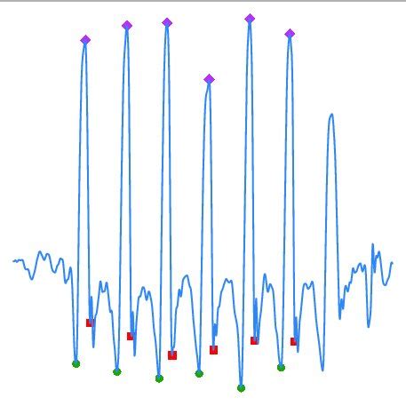 Placement Of The Wearable IMU Based Monitoring Devices A Placement
