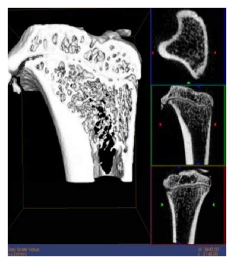 Micro Ct Of Femurs In Rats With Ovariectomy Induced Osteoporosis A