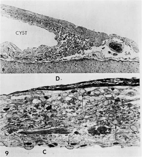 Figure 1 From Characterization Of Arachnoid Cysts Using Clinical