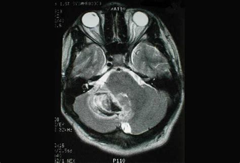 Central Vertigo Identifying The Hidden Cause