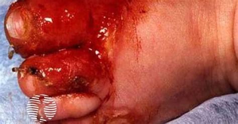 Acrodermatitis Enteropathica Image