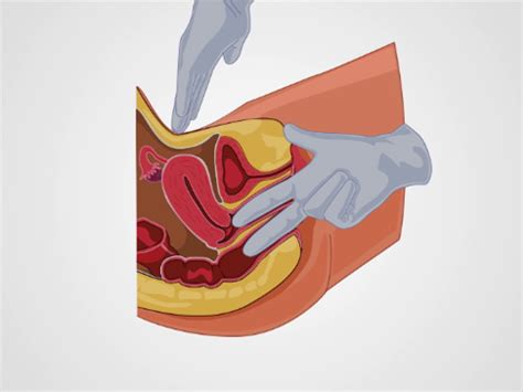 Video Pelvic Exam Iii Bimanual And Rectovaginal Exam