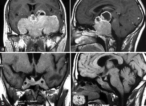 A Example Of A Huge Multidirectional Tumor With An Important Invasion Download Scientific
