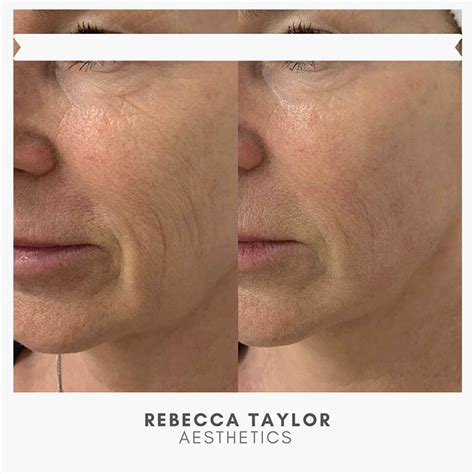 How Does Ultracel Q Hifu Treatment Work Rebecca Taylor