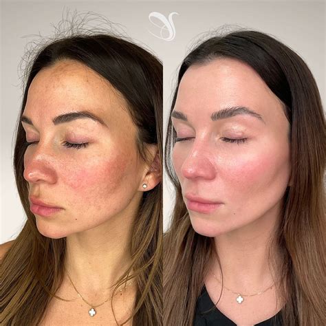 Skin Keeps Getting Better 😍 Swipe To See The Amazing Transformation