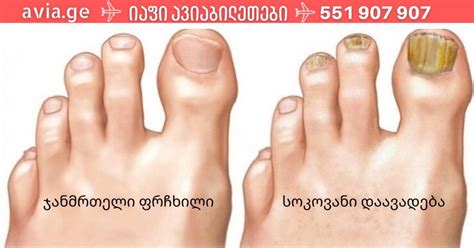 ფრჩხილის სოკოს 3 ხალხური საშუალება