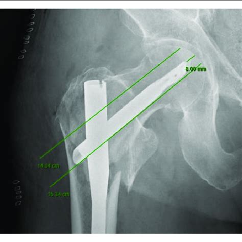 Example Of Varus Valgus Stem Position Evaluation In A Anteroposterior