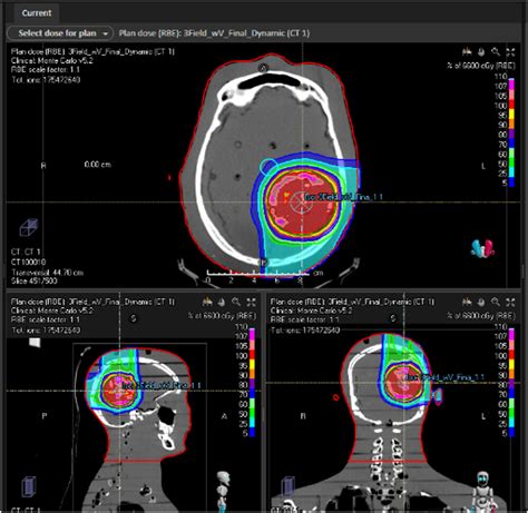 Measurements Of Fetal Dose With Mevion S250i Proton Therapy System With