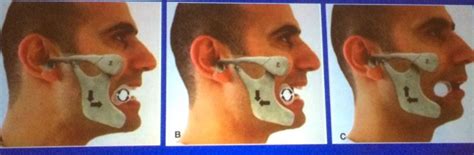 The Syringe Technique For Tmj Dislocations Sinaiem