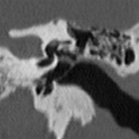 a et b IRM en coupes axiale a et sagittale b séquences T avec Download Scientific
