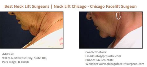 Get Rid Of That Extra Skin With Minimal Incision Neck Lift Neck Lift