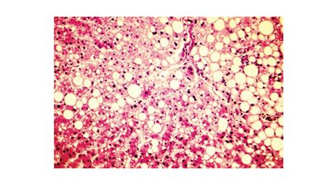 New Aasld Practice Guidance On Masld Gi And Endoscopy News Scope Forward