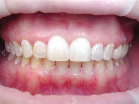 Can You Close The Gap Between My Front Teeth With Bonding Dr Mark Venincasa Dds General
