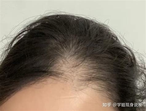 植发为什么会有脱落期？脱落期是正常的吗？植发脱落期该怎么办？ 知乎