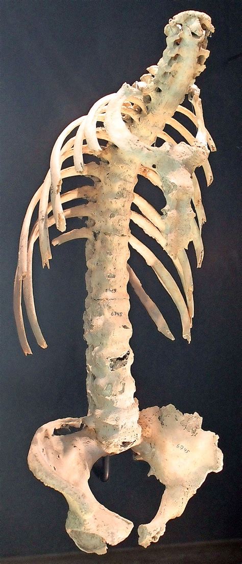 Ankilozirajoči Spondilitis Primorske Novice