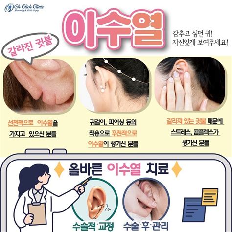 오클릭 클리닉 갈라진 귓불 이수열 👂💥 오클릭의원 에서 치료하고 이제 자신있게