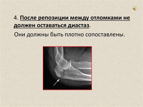 Основные принципы и методы лечения переломов костей презентация онлайн